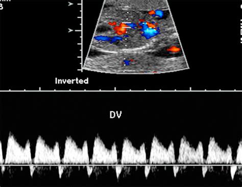 Ductus Venosus Waveform Doppler Ultrasound In Obstetrics Obstetrics
