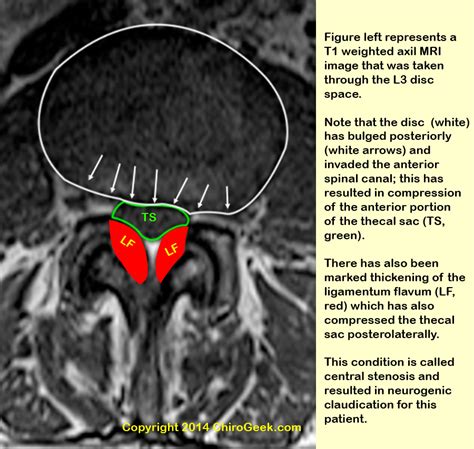 Thecal Sac Anatomy