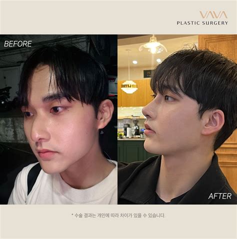 우리 눈 코 모델 모집해 사진 속 실제 환자분의 전후 확인해줘 ※ 수술 후 모습 리얼허거덩거덩스 기대해도 됨 신청 조건 매부리 복코 낮은코 등으로 스트레스를