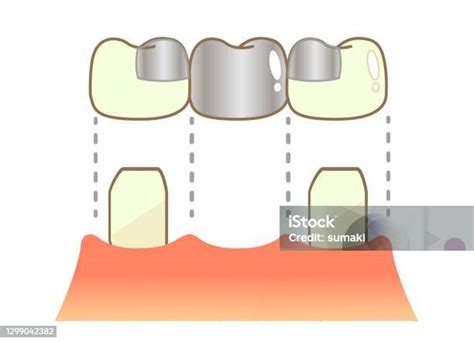틀니 크라운 브리지 임플란트 Pmtc 치과 실란트 카리스 합성 수지 Cr 접착제 복원 방법의 그림 C4에 대한 스톡 벡터 아트 및 기타 이미지 Istock