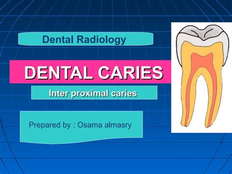 Dental Interproximal Caries Ppt Dental Health Diseases And Conditions