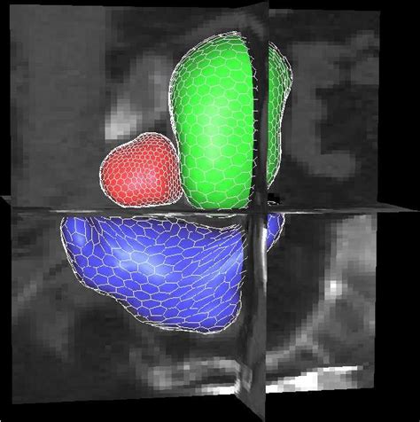 Figure 1 1 From Segmentation Of Anatomical Structures Of The Lower Abdomen Using 3d Deformable