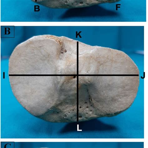 A Anteroposterior And Mediolateral Measurements Of Tibial Condyles Ab Download Scientific