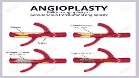 Neuro Interventional Procedures Pptx