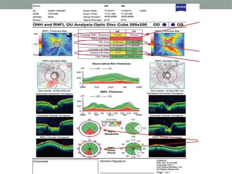 Diagnosis Of Pre Perimetric Glaucoma Pptx