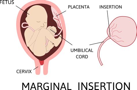 Marginal Cord Insertion Birth Injuries Chicago Birth Injury Lawyer