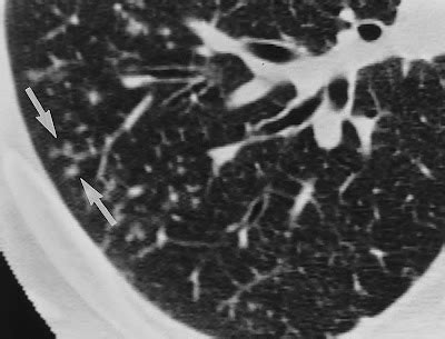 ON RADIOLOGY CT Sign Of Tree In Bud Appearance