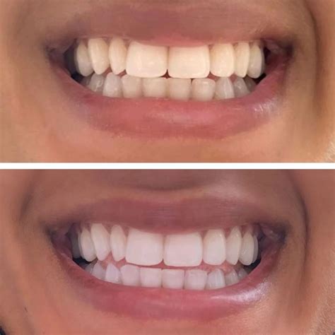 Smile White Teeth Whitening Review Best For Professional Results