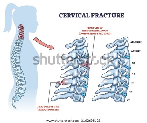 Spinous Process Fracture