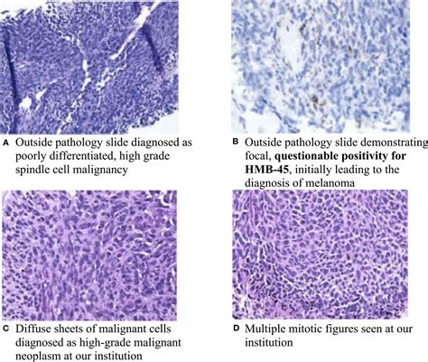 Spindle Cell Sarcoma Treatment At Victoria Jenkins Blog