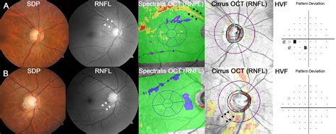 Clinical Usefulness Of Layer By Layer Deviation Maps Of Spectralis Oct Comparison With Cirrus
