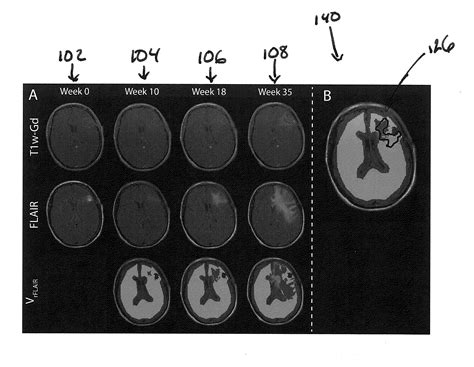 Voxel Based Approach For Disease Detection And Evolution Eureka Patsnap