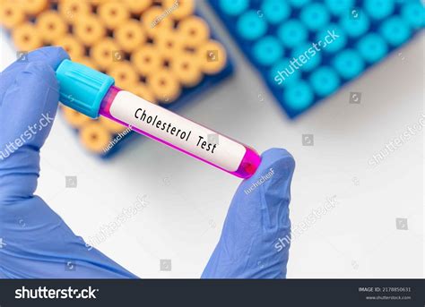Cholesterol Test Result Blood Sample Test Stock Photo 2178850631 Shutterstock