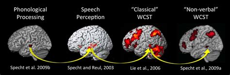 Superior Temporal Sulcus
