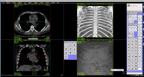 带三维重建和还原功能的医学影像管理系统(pacs)源码 带三维重建和还原功能的医学影像管理系统(pacs)源码