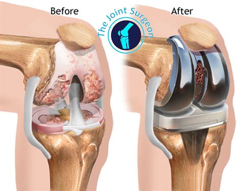 Is Knee Replacement Surgery Common Knee Replacement Hot Sex Picture