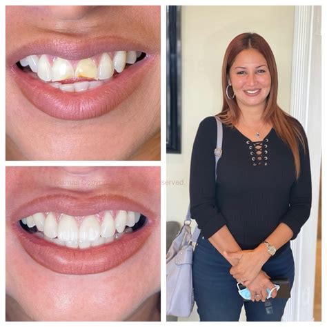 Veneers Before And After India At Lillian Villarreal Blog