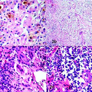 Primary Sclerosing Cholangitis PSC ERCP Shows Stenosis And Beaded Download Scientific
