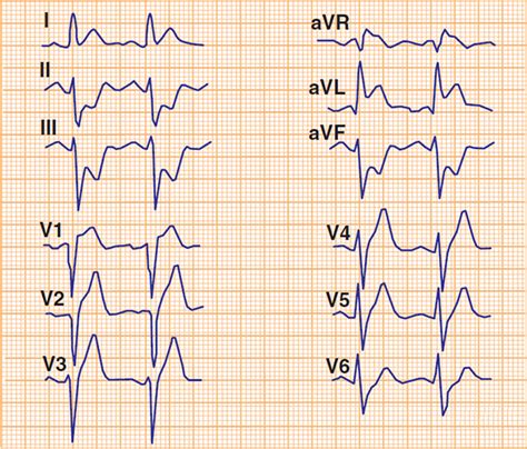 Anterior Stemi Localization Of Lad Occlusion Ecg Book