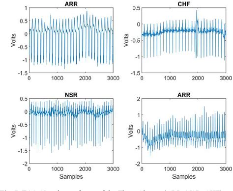 figure 1 from ecg multi class classification using machine learning