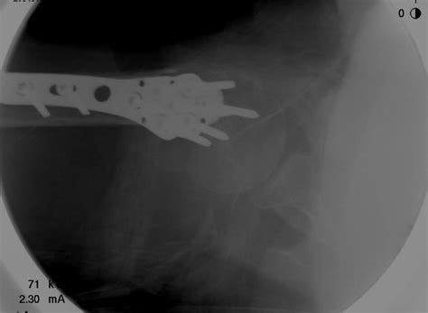 Shoulder And Elbow Surgery The Deforming Forces In Proximal Humerus