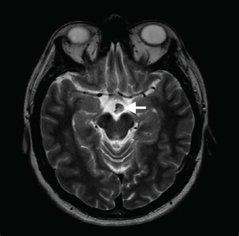 A Sagittal Brain Ct Without Contrast B Sagittal T1 Weighted Mri Download Scientific