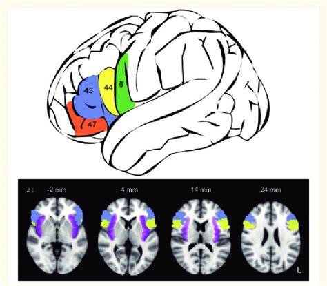 Brocas Area Adjacent Frontal Operculum And The Insula Are Commonly