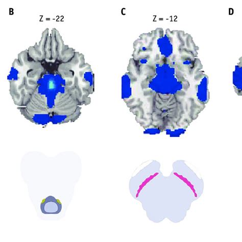 The Locational Relationships Between Lesion Network Mapping For Rapid