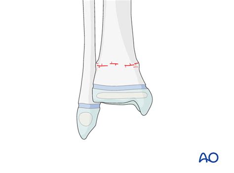 Torusbuckle Fracture Of The Distal Tibial Metaphysis