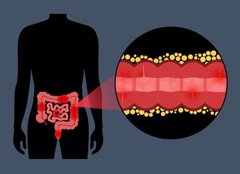 Flebite Quali Sono I Sintomi E Quando Preoccuparsi