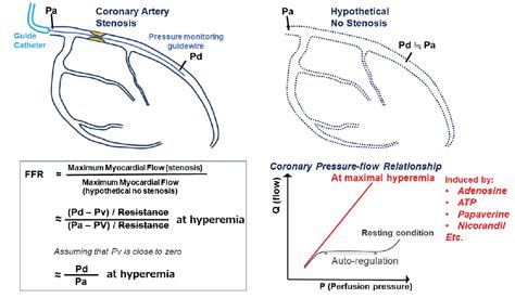 Ffr Ifr And Other Resting Indices Pressure Wire Based Assessment Of Ischemia Cardiac