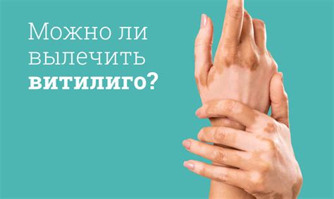 Лечение витилиго Мази кремы гели витамины таблетки