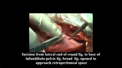 Stepwise Devascularization Of Uterus Youtube