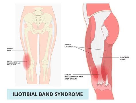 Iliotibial Band Syndrome Itbs A Common Overuse Injury