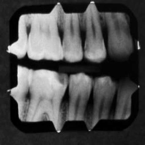 Caries Detection Object Detection Dataset By Shreku