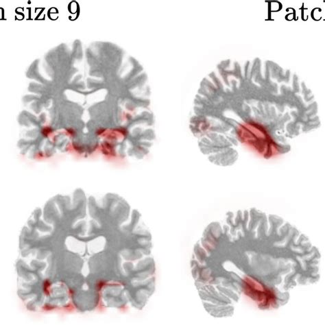 Difference In The Positive Patch Level Class Evidence Produced By The