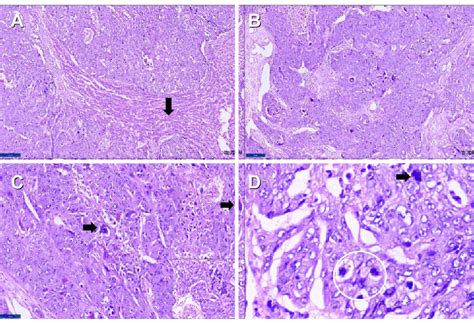 Photomicrographs Showing A Tumor Cells Infiltrating Liver Parenchyma Download Scientific