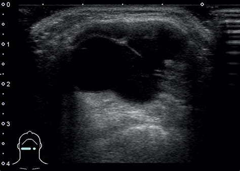Thyroglossal Duct Cyst Ultrasound