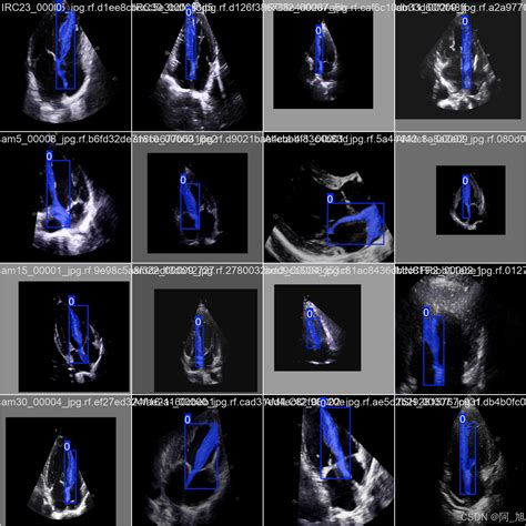 基于yolo11深度学习的心脏超声图像间隔壁检测分割与分析系统【python源码pyqt5界面数据集训练代码】深度学习实战、目标分割