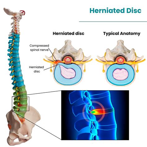 Herniated Disc Mri Scan Midtown Manhattan