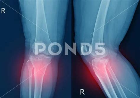 X Ray Knee Fracture Proximal Metaphysis Of Tibia Depressed Fracture Of