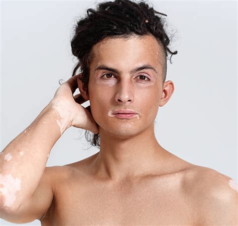 Uvb Lamps For Vitiligo Uv Light Vitiligo Treatment Ny Usa