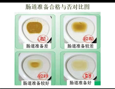 肠镜前肠道准备图片肠镜肠道准备标准图片第2页大山谷图库