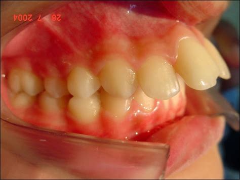 Odontologia Total Classificação Das Maloclusões De Angle