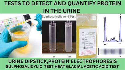 Detection And Quantification Of Proteinuriaurine Dipstick
