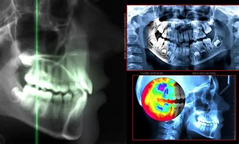 Cephalometric Radiograph And Analysis