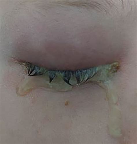 The Pediatric Infectious Disease Journal