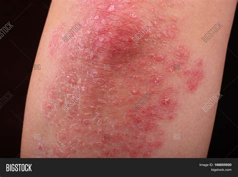 Bumps On Elbows