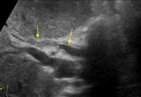 Ascending Cholangitis Causes Symptoms Diagnosis Treatment And Prognosis