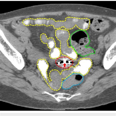 Ct Images Used For Treatment Planning Of Brachytherapy With Oral